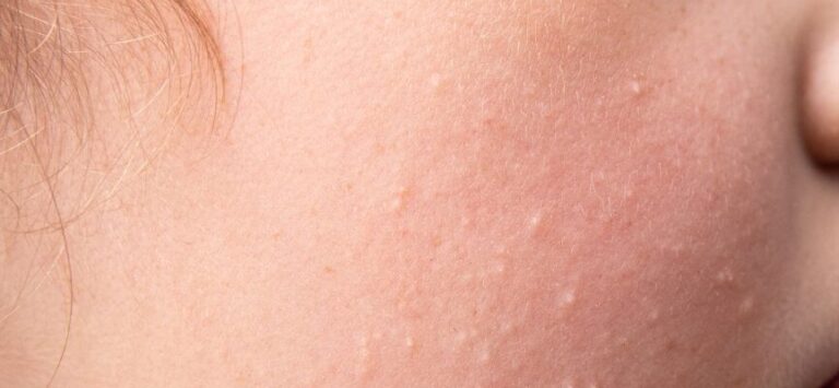 Lumps & bumps - Varna Pigmentation
